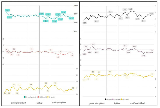 Continuous Maternal Hemodynamics Monitoring at Delivery Using a Novel ...