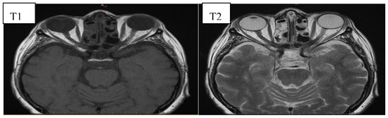 Current Knowledge on Graves’ Orbitopathy