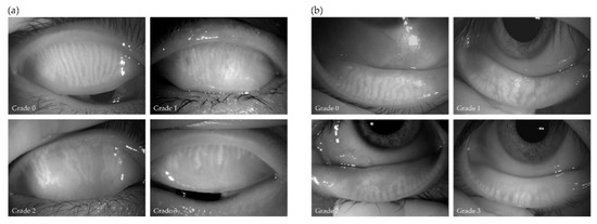 Proposed Algorithm for Management of Meibomian Gland Dysfunction Based ...