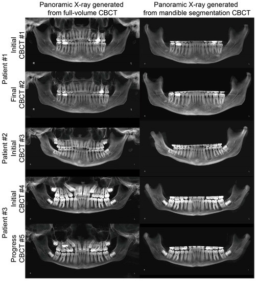 A User-Friendly Protocol for Mandibular Segmentation of CBCT Images for ...