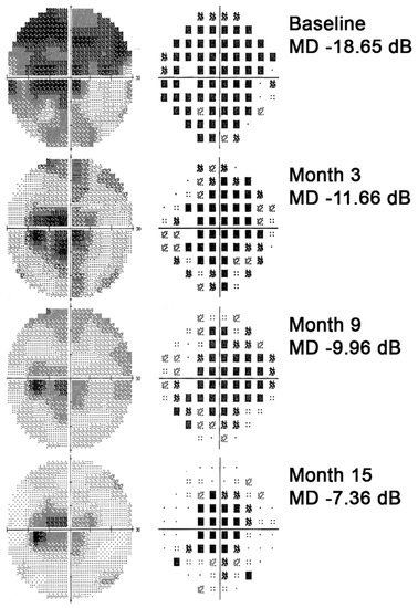 Changes in Visual Function and Correlations with Inner Retinal ...