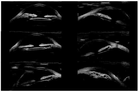Clinical Features of Iris Cysts in Long-Term Follow-Up