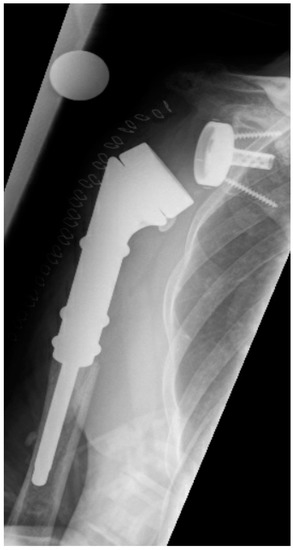 Clinical Outcome of Two-Stage Revision after Periprosthetic Shoulder ...