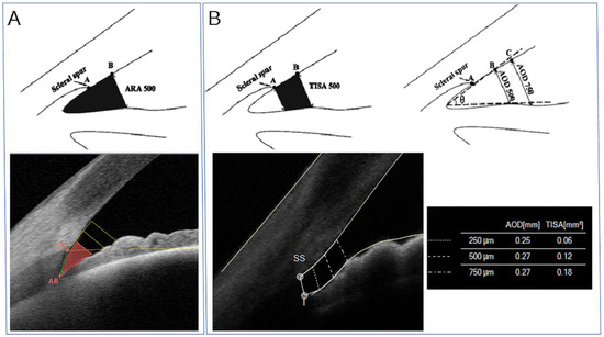 The Use of Anterior-Segment Optical-Coherence Tomography for the ...