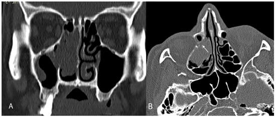 Assessment of Lacrimal Duct Patency in Patients Undergoing Endoscopic ...