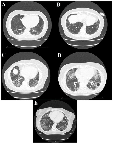 Imaging in Diagnosis of Systemic Sclerosis