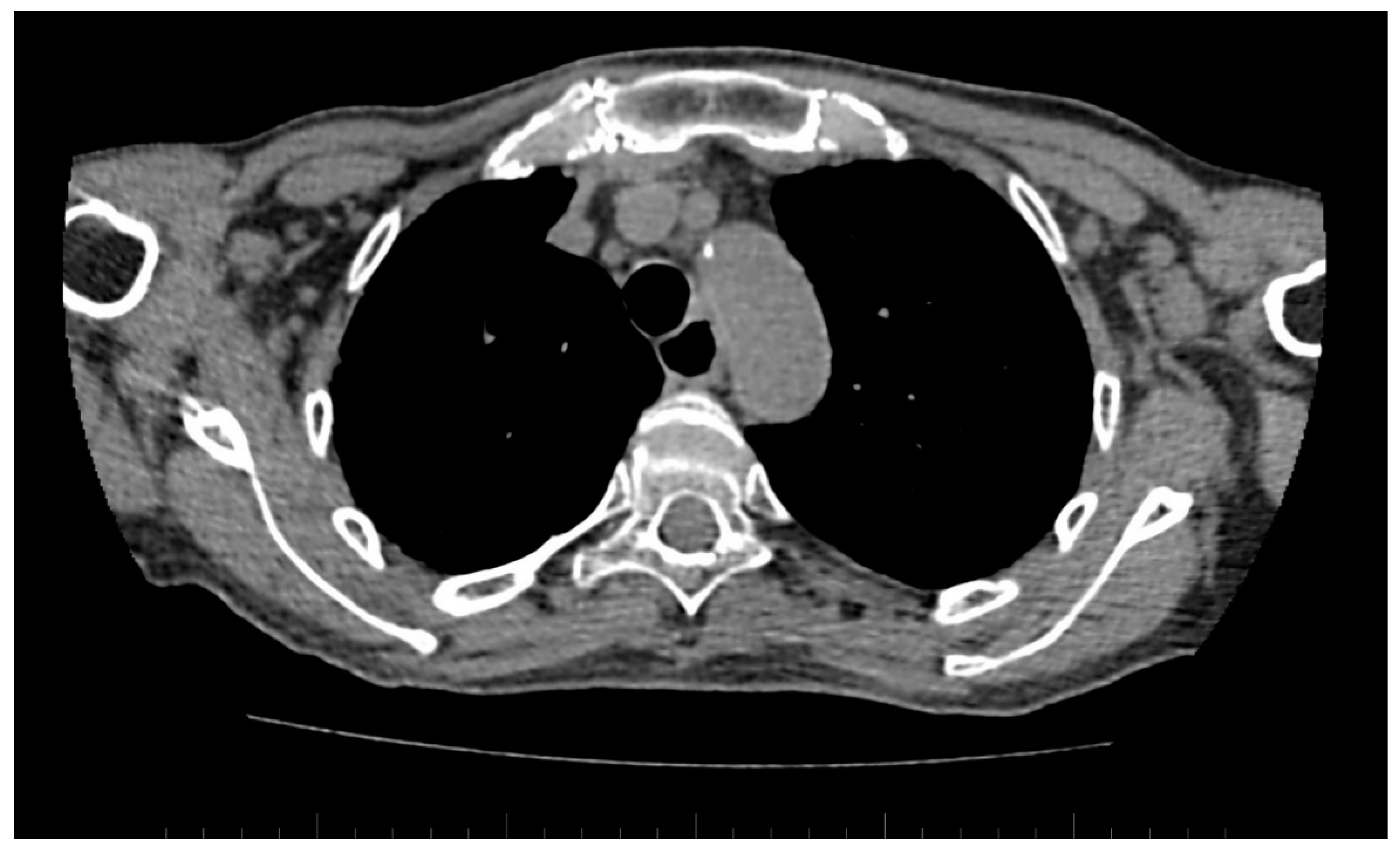 Imaging in Diagnosis of Systemic Sclerosis