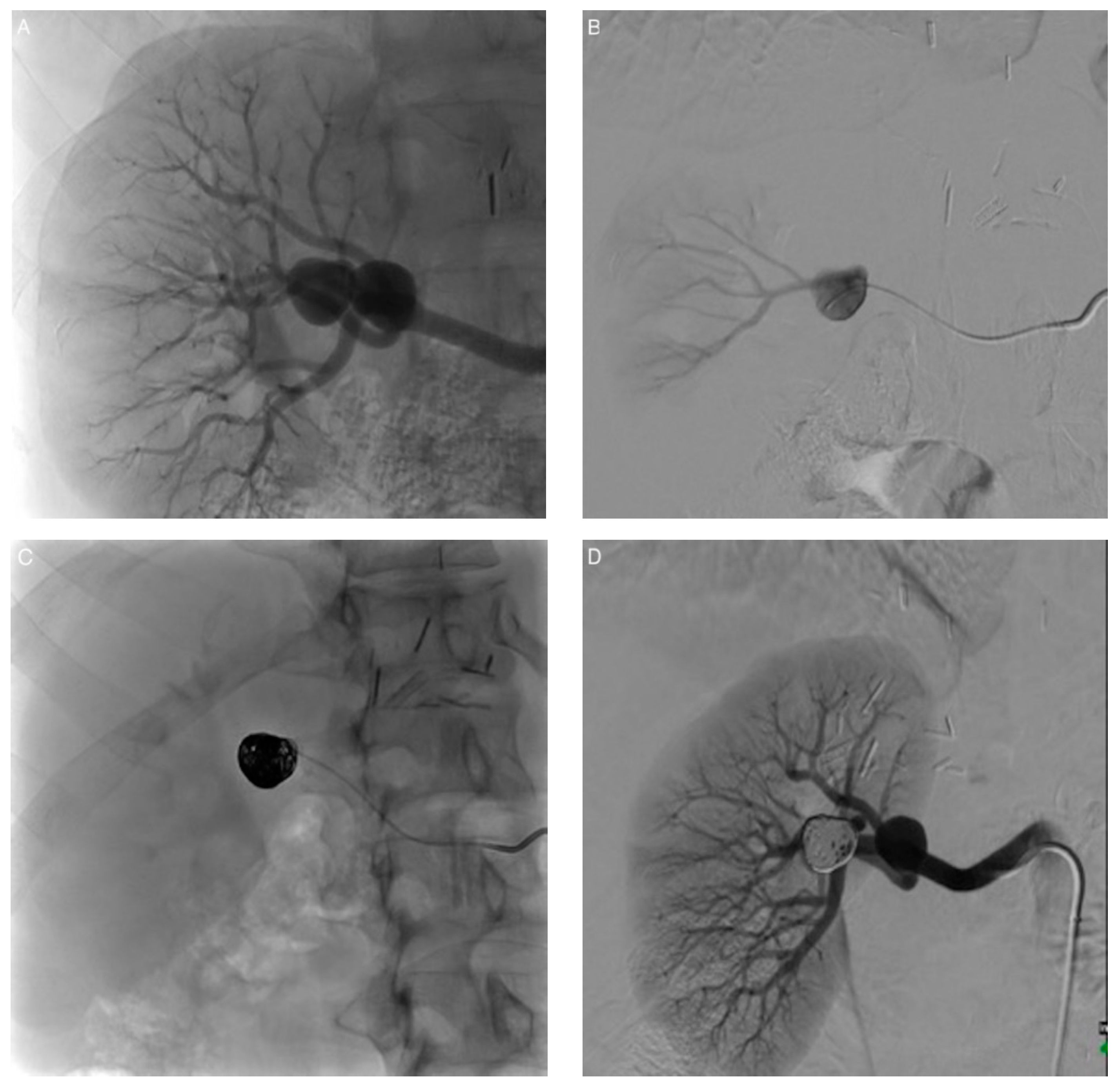 Packing Technique With Or Without Remodeling For Endovascular Coil