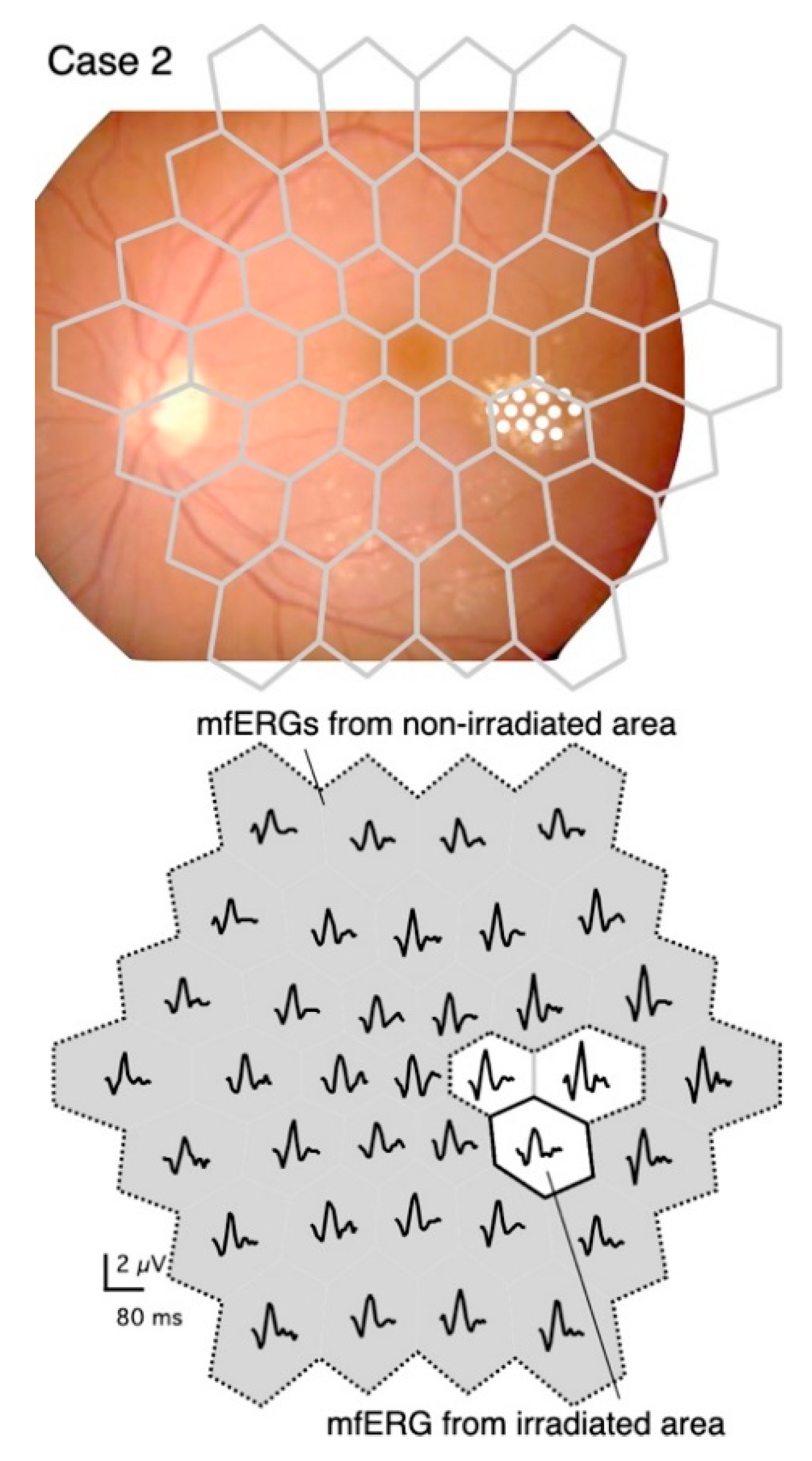 Transient Increase and Delay of Multifocal Electroretinograms Following ...