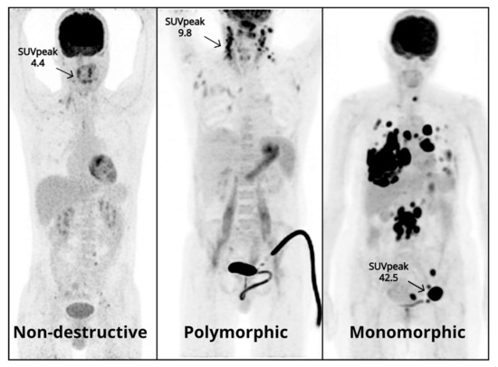 Semi-Quantitative Characterization of Post-Transplant ...