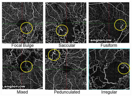 Multimodal Imaging of Microvascular Abnormalities in Retinal Vein Occlusion