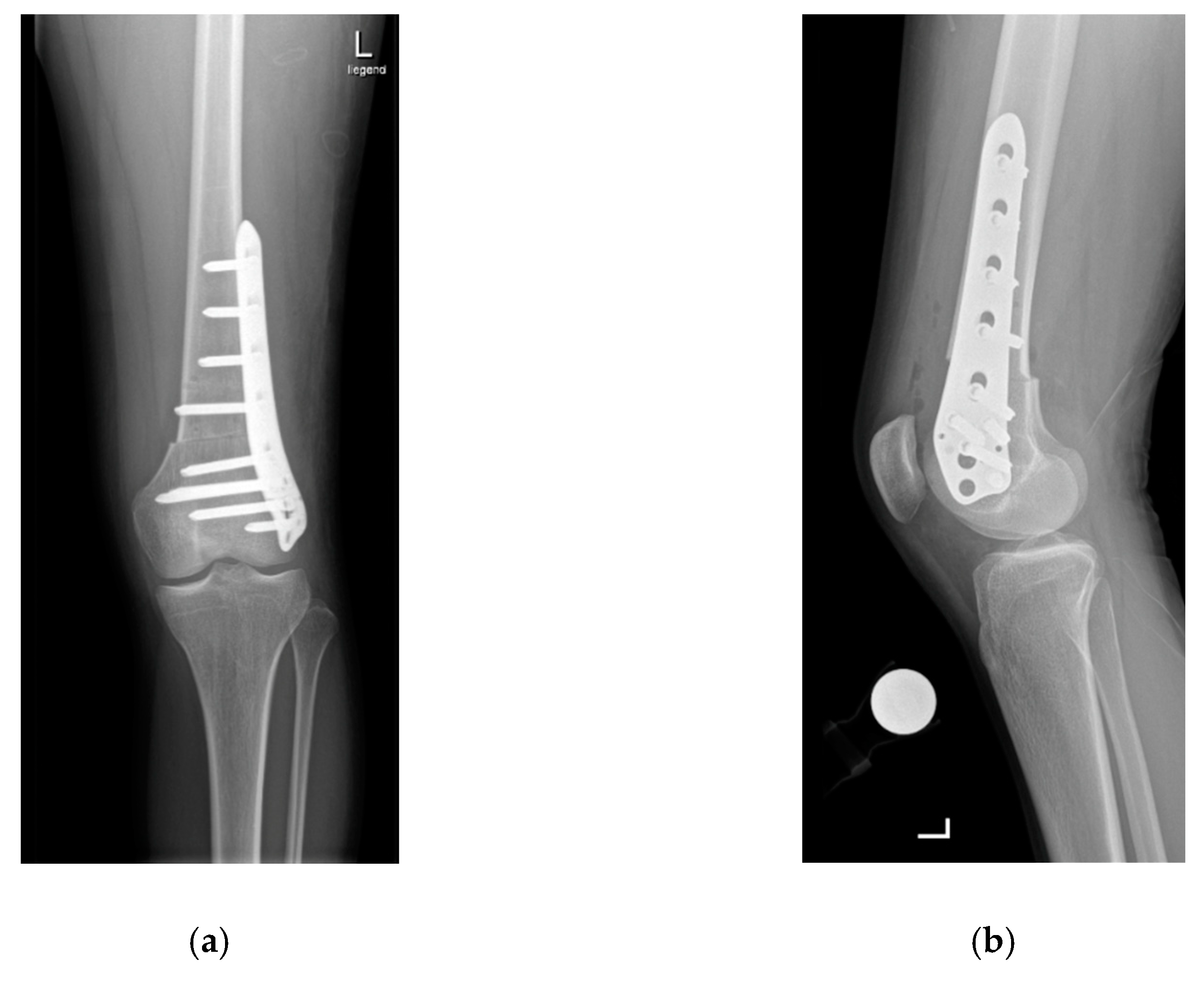 Reflections on Rotational Osteotomies around the Patellofemoral Joint