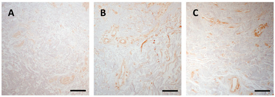 Dermal Alterations in Clinically Unaffected Skin of Pseudoxanthoma ...