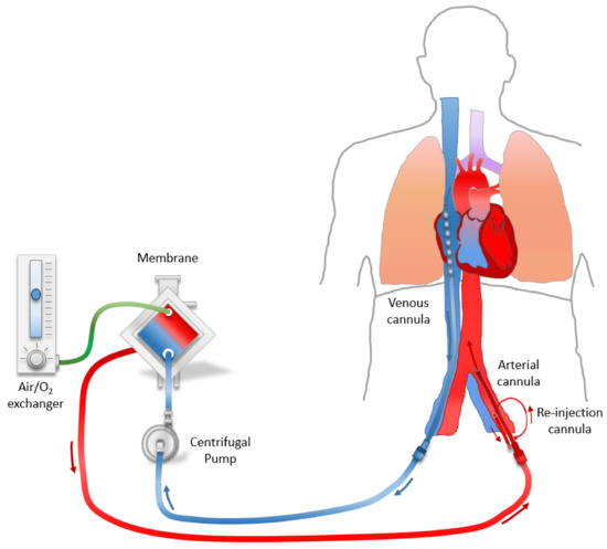 ECMO in Cardiac Arrest: A Narrative Review of the Literature