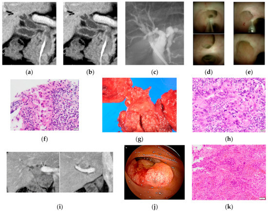 JCM | Free Full-Text | Peroral Cholangioscopy-Guided Forceps Mapping ...