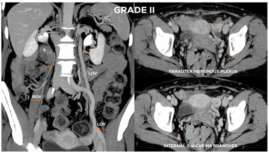 Hemodynamic and Radiological Classification of Ovarian Veins System ...