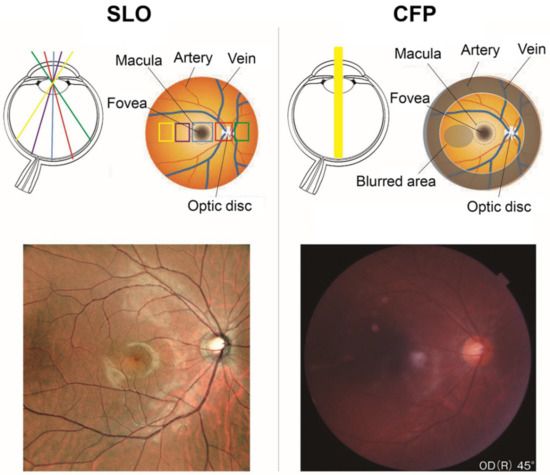 Recent Advances and Clinical Application of Color Scanning Laser ...