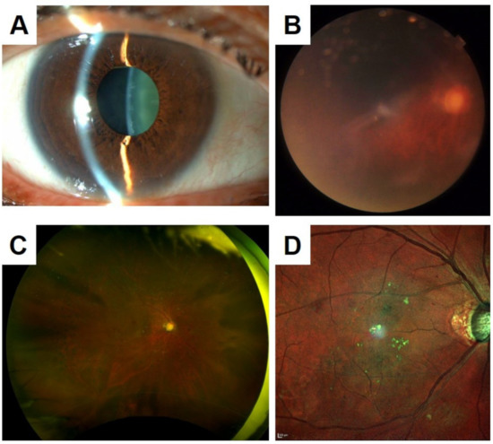 Recent Advances and Clinical Application of Color Scanning Laser ...