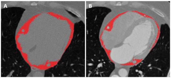 Subcutaneous, Paracardiac, and Epicardial Fat CT Density Before/After ...