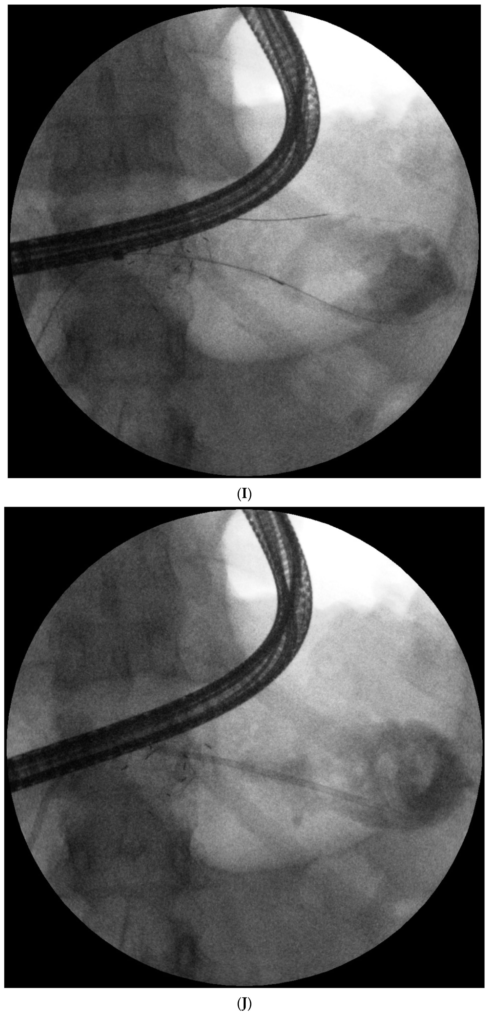 The Role of Endoscopic Transpapillary Stenting of the Main Pancreatic ...