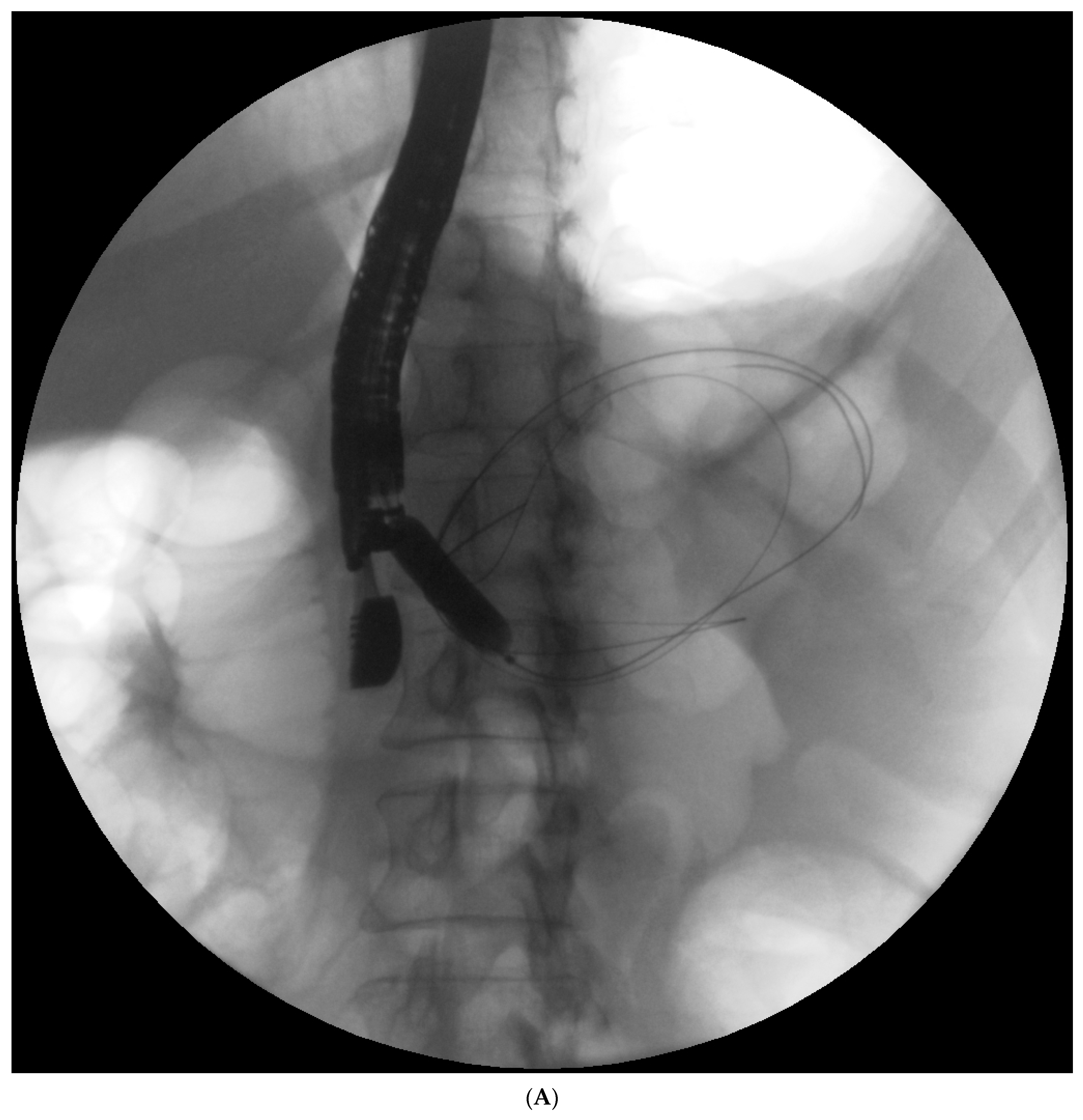 The Role of Endoscopic Transpapillary Stenting of the Main Pancreatic ...