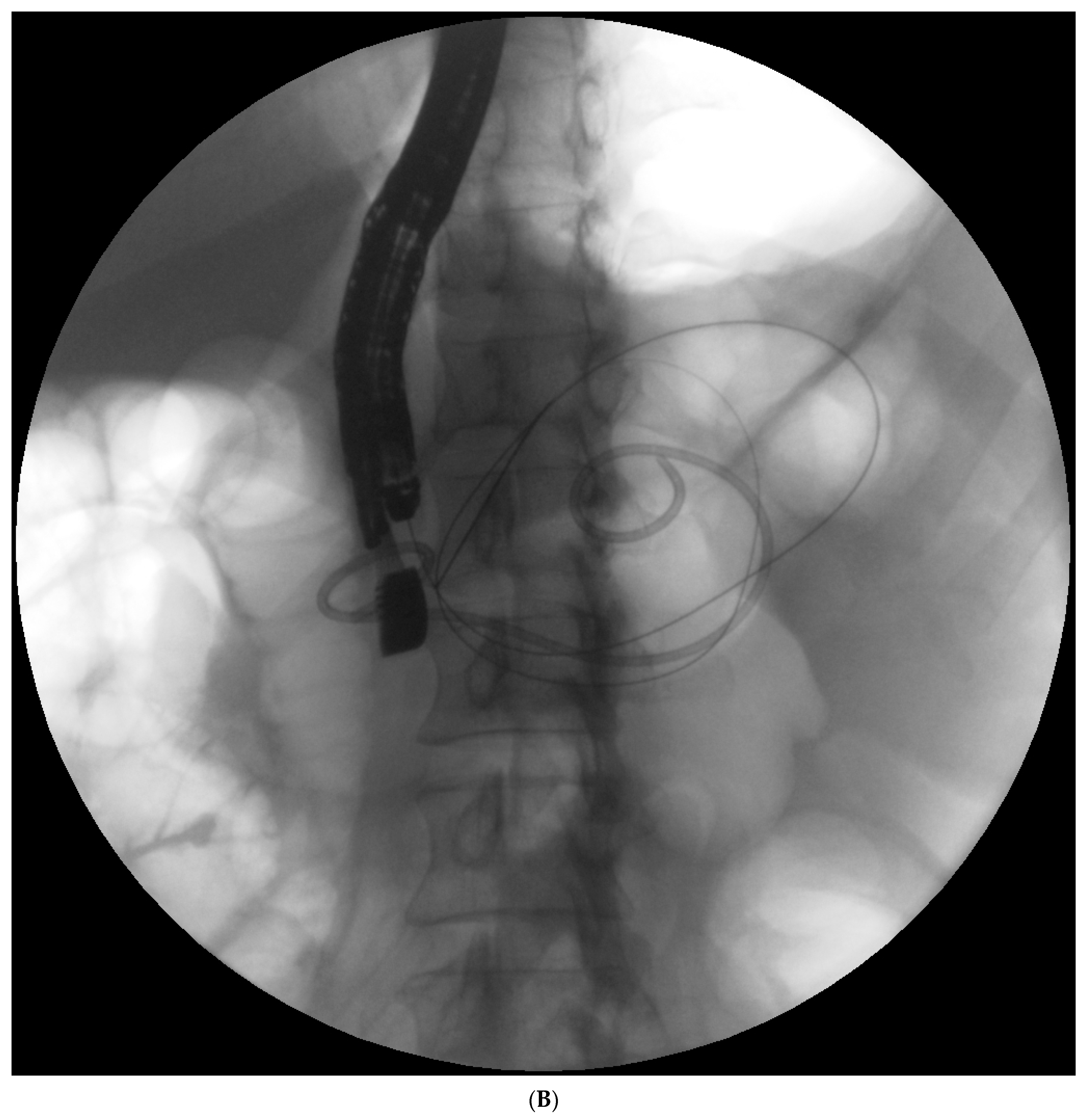 The Role of Endoscopic Transpapillary Stenting of the Main Pancreatic ...