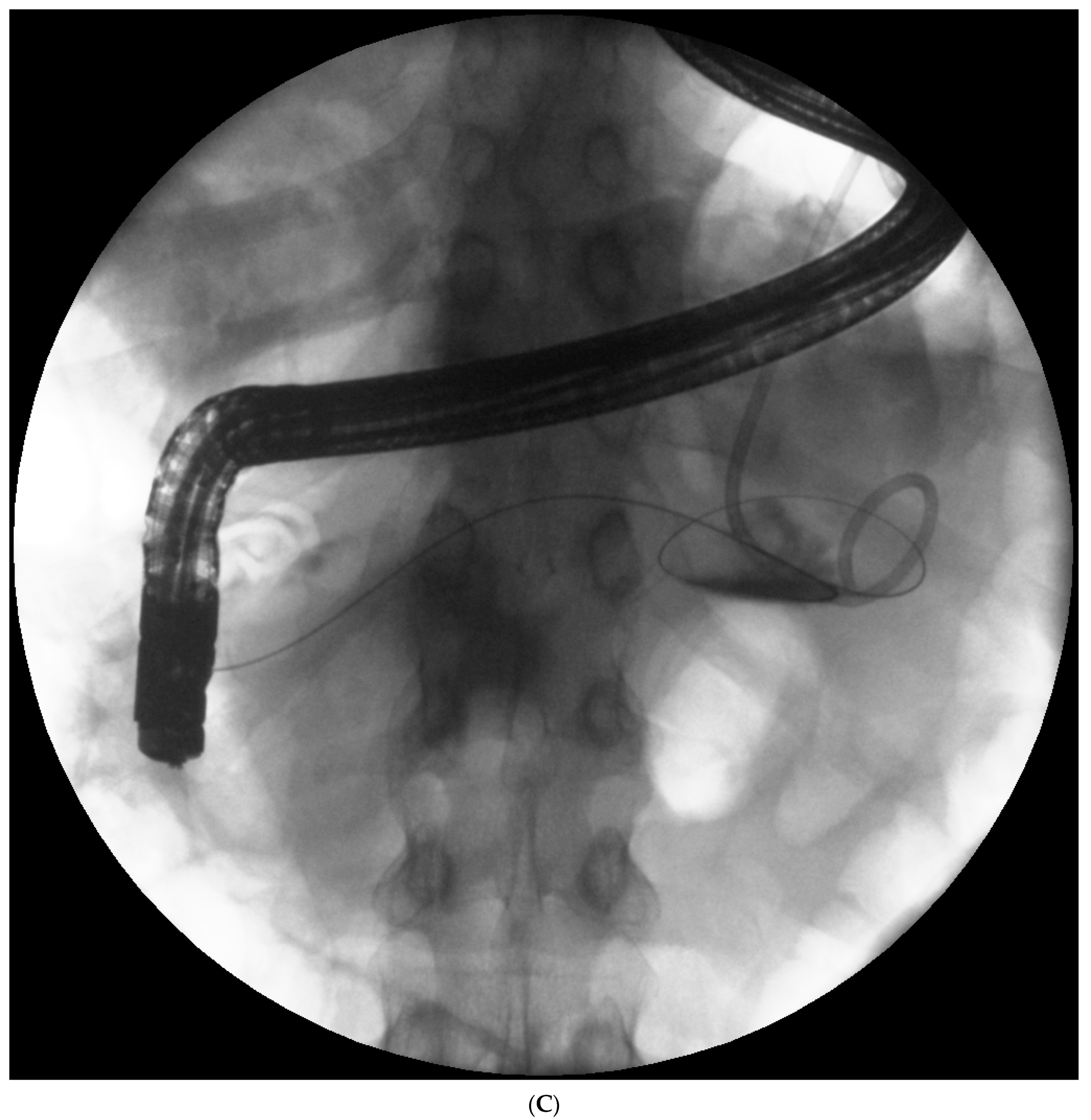 The Role of Endoscopic Transpapillary Stenting of the Main Pancreatic ...