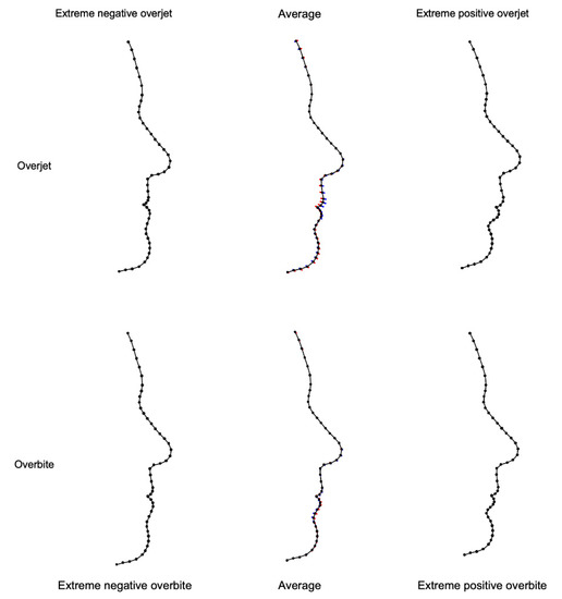 Incisor Occlusion Affects Profile Shape Variation in Middle-Aged Adults
