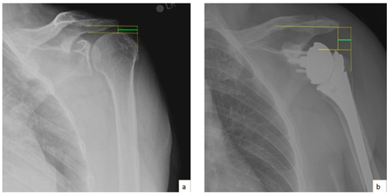 Negligible Correlation between Radiographic Measurements and Clinical ...