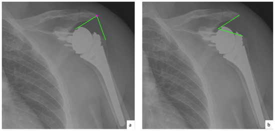 Negligible Correlation between Radiographic Measurements and Clinical ...