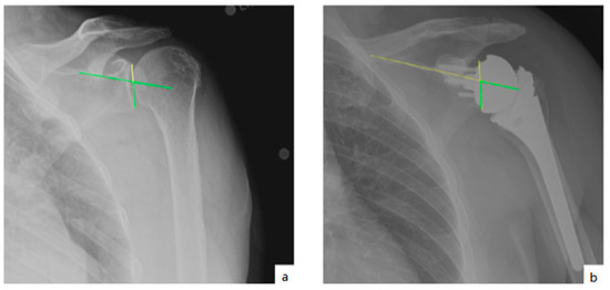 Negligible Correlation between Radiographic Measurements and Clinical ...
