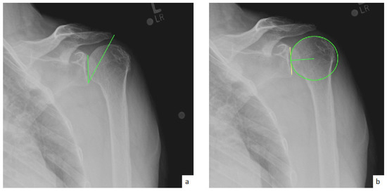 Negligible Correlation between Radiographic Measurements and Clinical ...