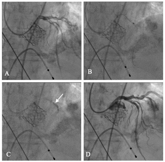 Aortic Valve Disease and Associated Complex CAD: The Interventional ...