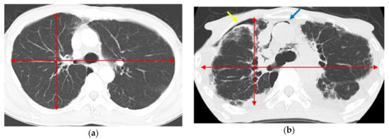 Lung Transplantation for Pleuroparenchymal Fibroelastosis