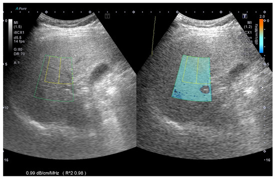 Attenuation Imaging with Ultrasound as a Novel Evaluation Method for ...