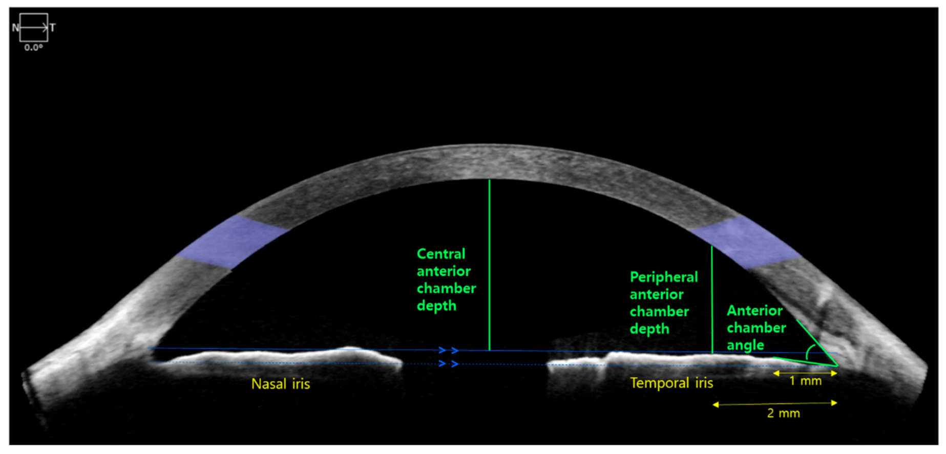 Anterior Chamber Angle