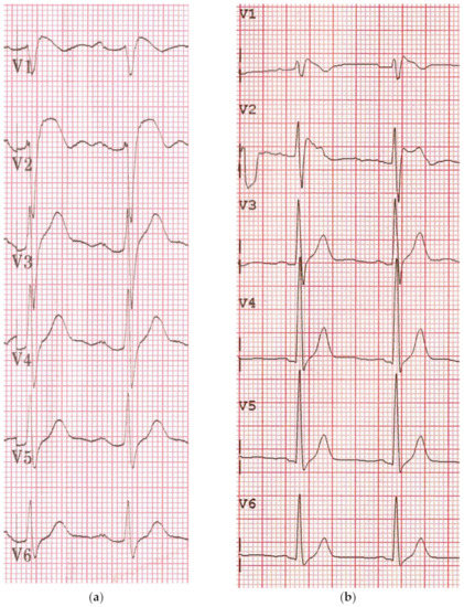 Role of Provocable Brugada ECG Pattern in The Correct Risk ...