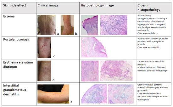 Cutaneous Manifestations in Biological-Treated Inflammatory Bowel ...