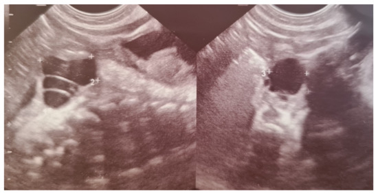 Gynecological Problems in Newborns and Infants