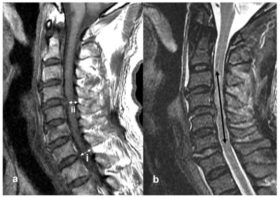 Adult Spinal Cord Injury without Major Bone Injury: Effects of Surgical ...