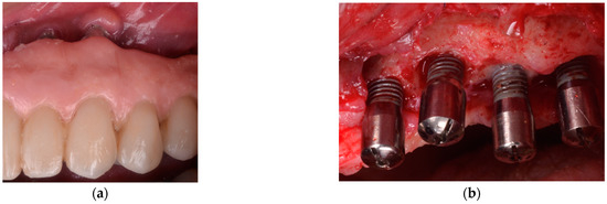 Peri-Implantitis: A Clinical Update on Prevalence and Surgical ...