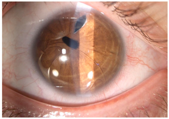 Iris-Claw Intraocular Lens Implantation in Various Clinical Indications ...