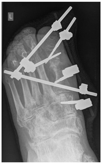 Possible Advantages of S53P4 Bioactive Glass in the Treatment of Septic ...