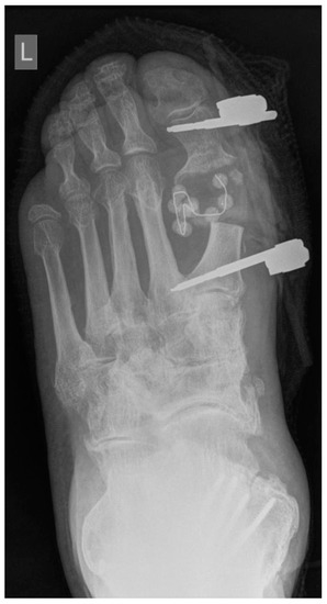 Possible Advantages of S53P4 Bioactive Glass in the Treatment of Septic ...