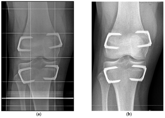 Temporary Proximal Tibial Epiphysiodesis for Correction of Leg Length ...