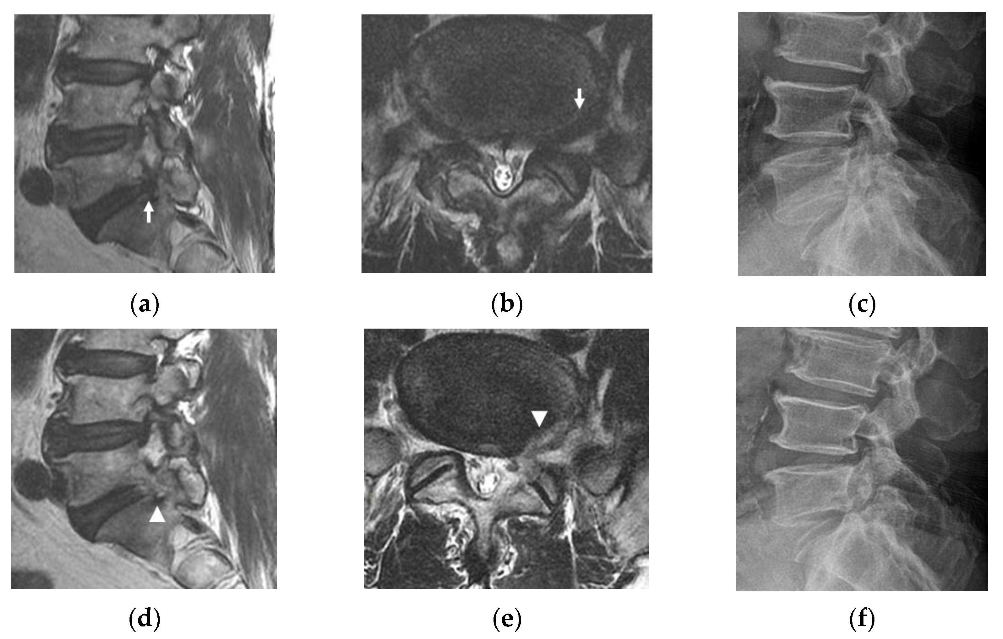 The Novel Technique of Uniportal Endoscopic Interlaminar Contralateral ...