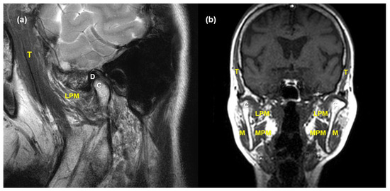 MRI-Based Assessment of Masticatory Muscle Changes in TMD Patients ...