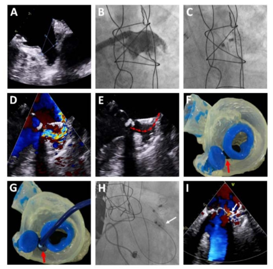 JCM | Free Full-Text | Left Atrial Appendage Closure with a New ...