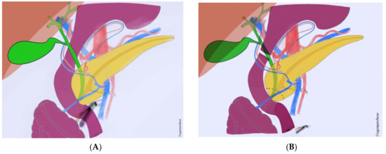 Parenchymal Sparing Resection: Options in Duodenal and Pancreatic Surgery