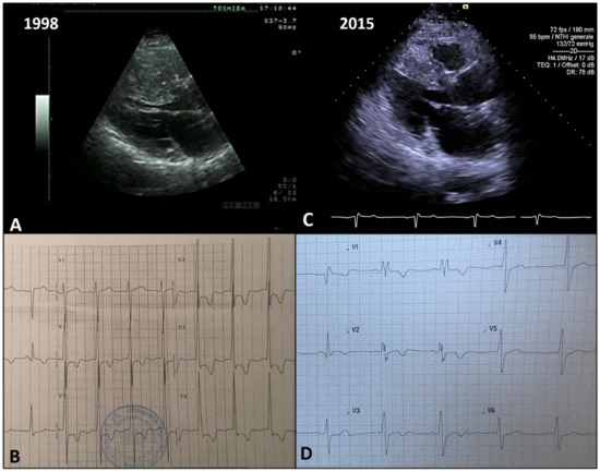 Left Ventricular Remodeling in Hypertrophic Cardiomyopathy: An Overview ...